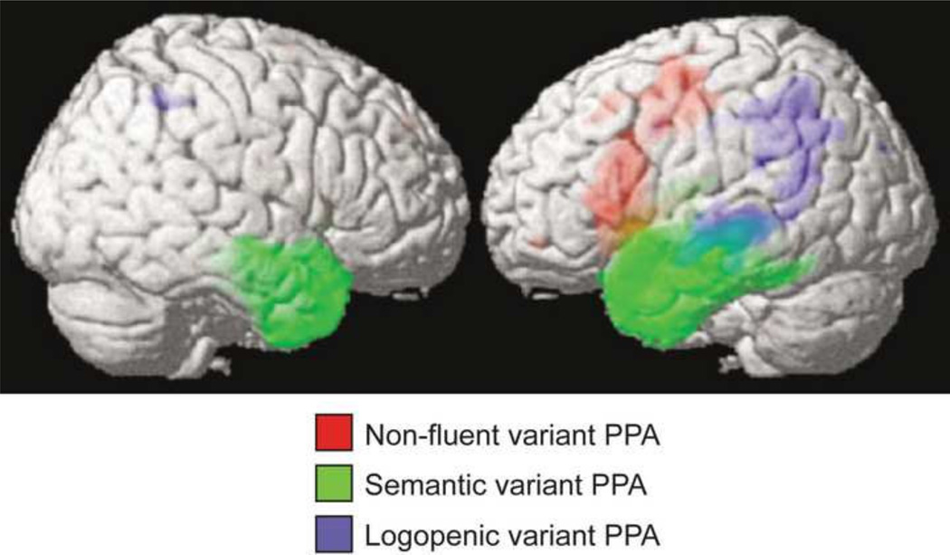 dementia typesAlzheimer's front temporal vascular dementia posterior ...